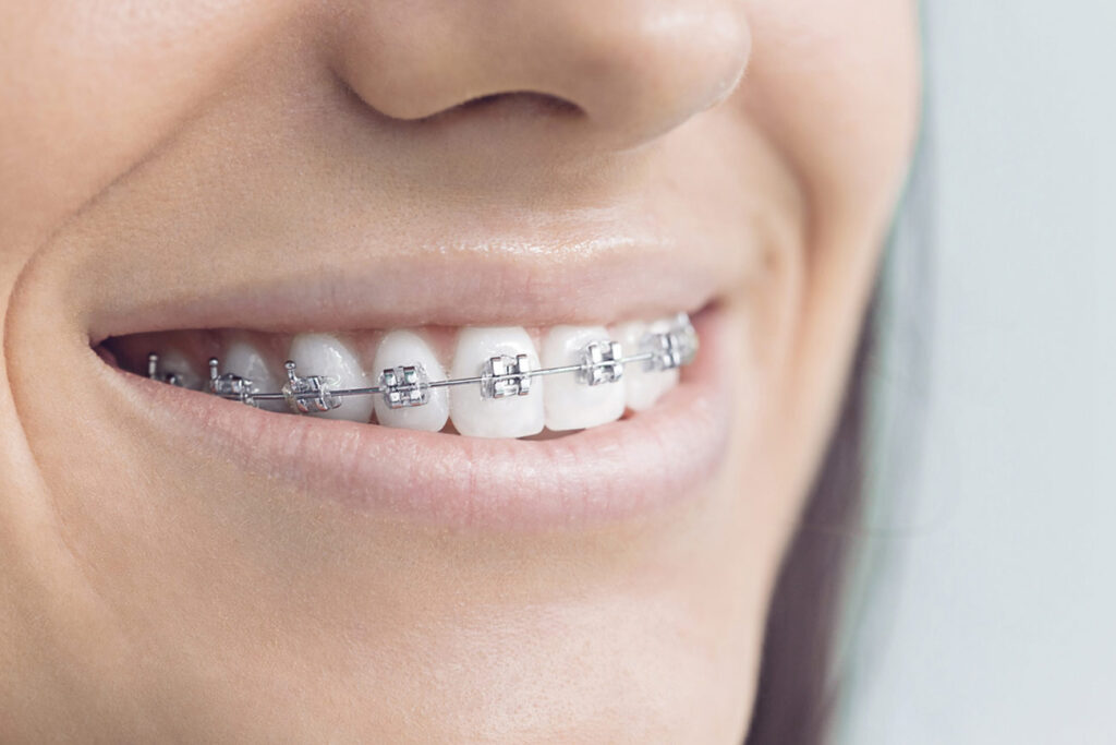 Apparecchio ortodontico fisso - Studio Dentistico Luigi Galasso